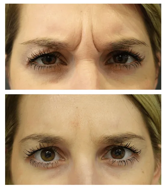 Botox - Dysport - Xeomin - Facial Muscle Treatment | Innovative ...